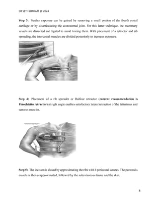 THORACOTOMY . SURGICAL PERSPECTIVES VOL 1 | PDF