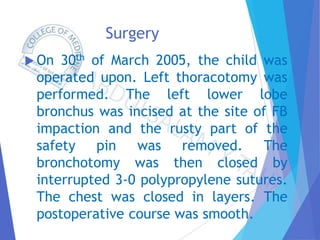 Thoracotomy for a Long-Standing Bronchial Foreign Body.pdf