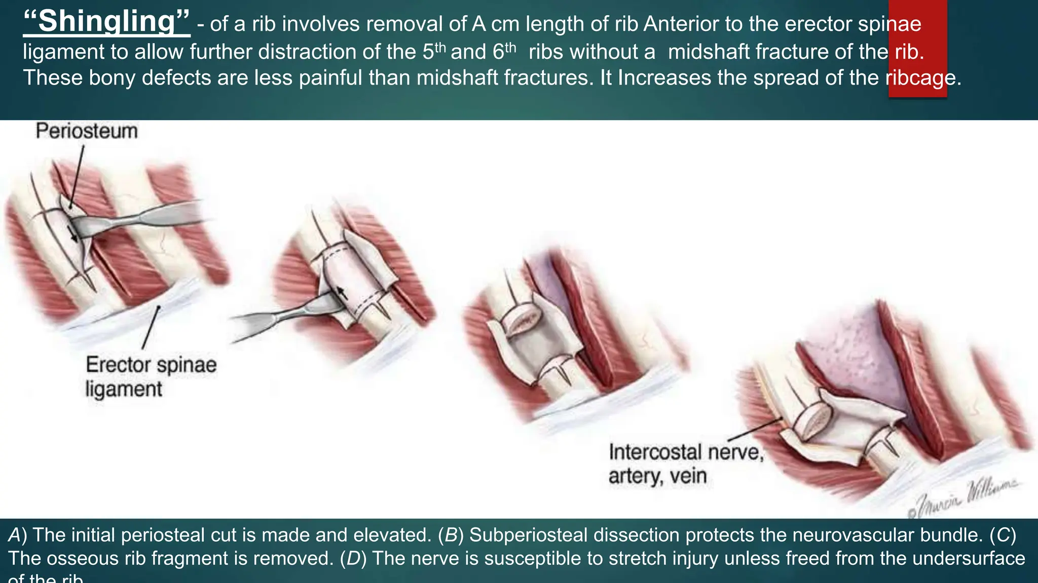 THORACOTOMY INCISION ppt by Dr. Amrit kumar | PPTX