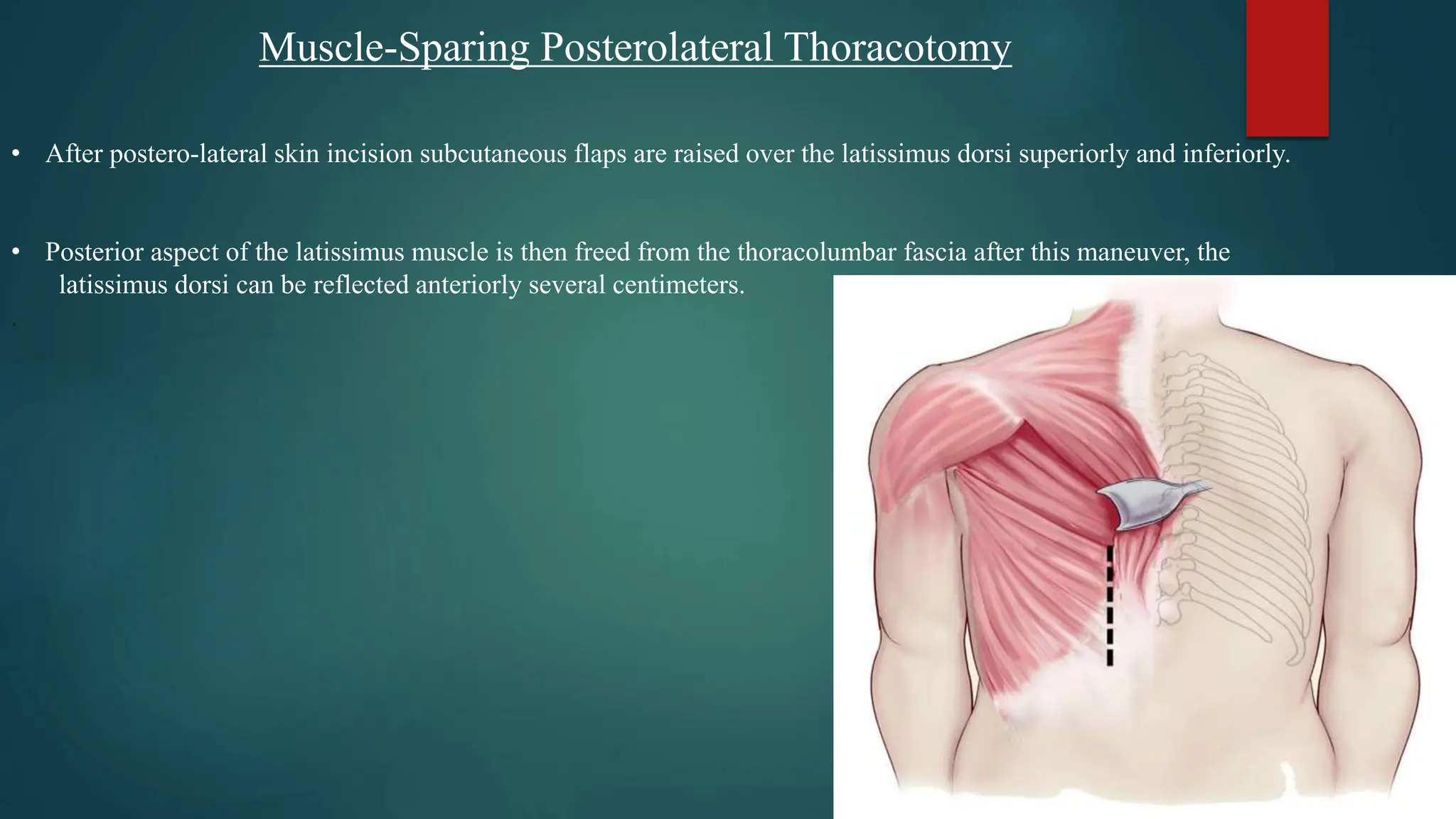 THORACOTOMY INCISION ppt by Dr. Amrit kumar | PPTX