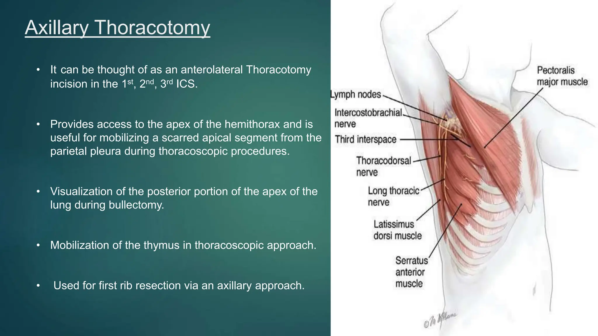 THORACOTOMY INCISION ppt by Dr. Amrit kumar | PPTX
