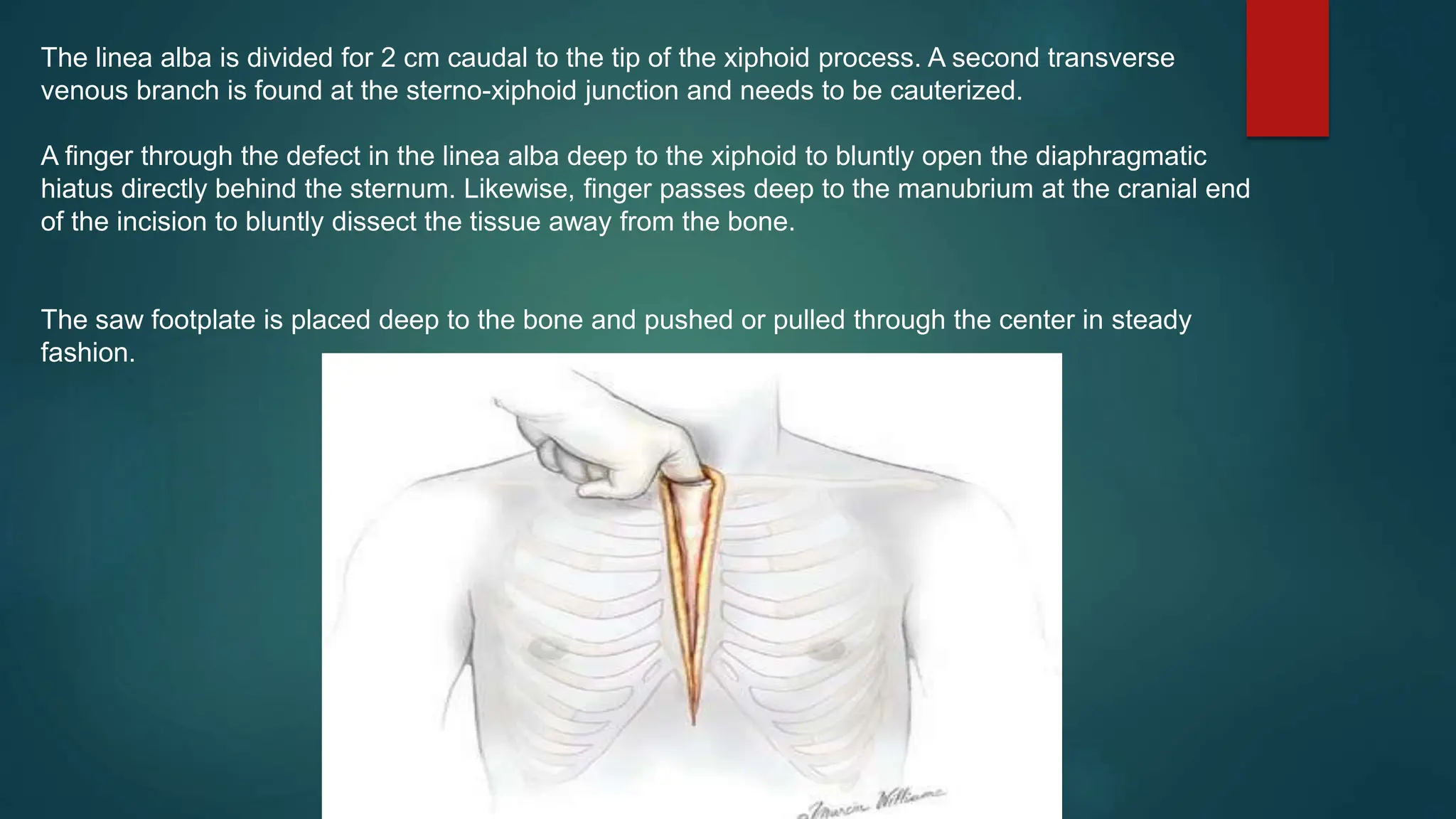 THORACOTOMY INCISION ppt by Dr. Amrit kumar | PPTX