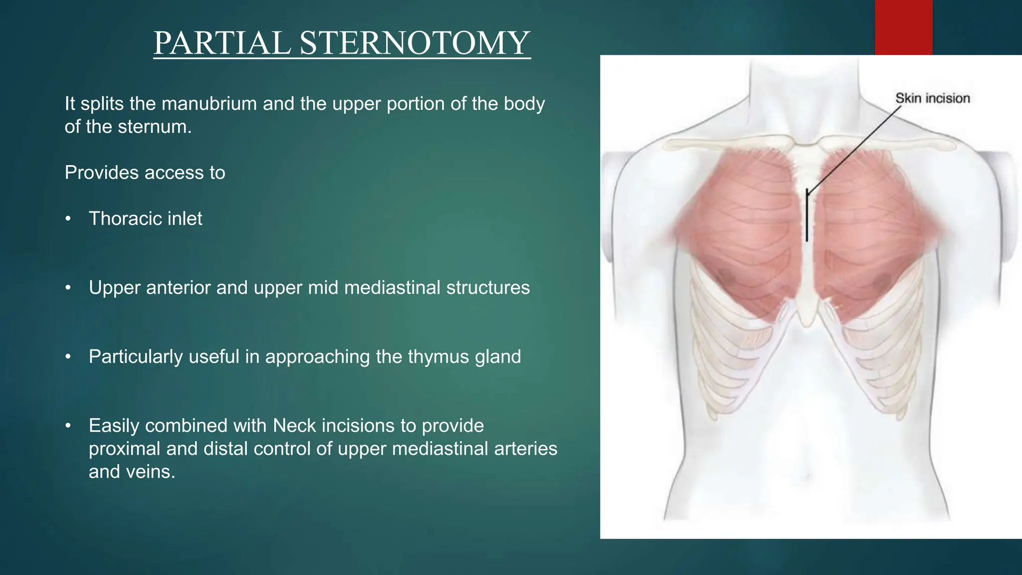 THORACOTOMY INCISION ppt by Dr. Amrit kumar | PPTX
