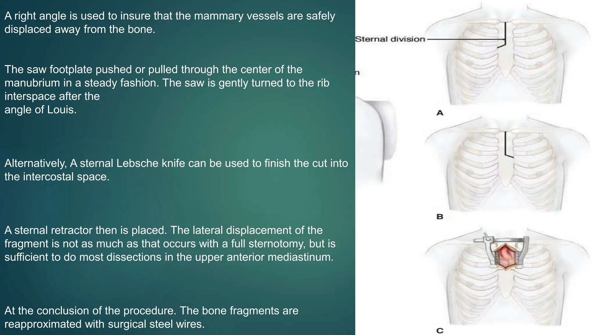 THORACOTOMY INCISION ppt by Dr. Amrit kumar | PPTX