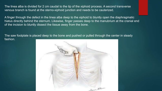 THORACOTOMY INCISION ppt by Dr. Amrit kumar | PPTX | Death, Injury, or ...