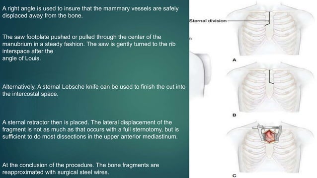 THORACOTOMY INCISION ppt by Dr. Amrit kumar | PPTX | Death, Injury, or ...