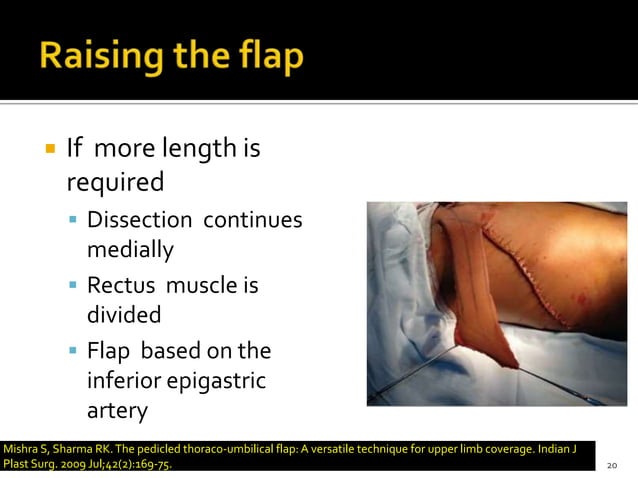 THORACOUMBILICAL FLAP DR VIPIN V NAIR | PPTX