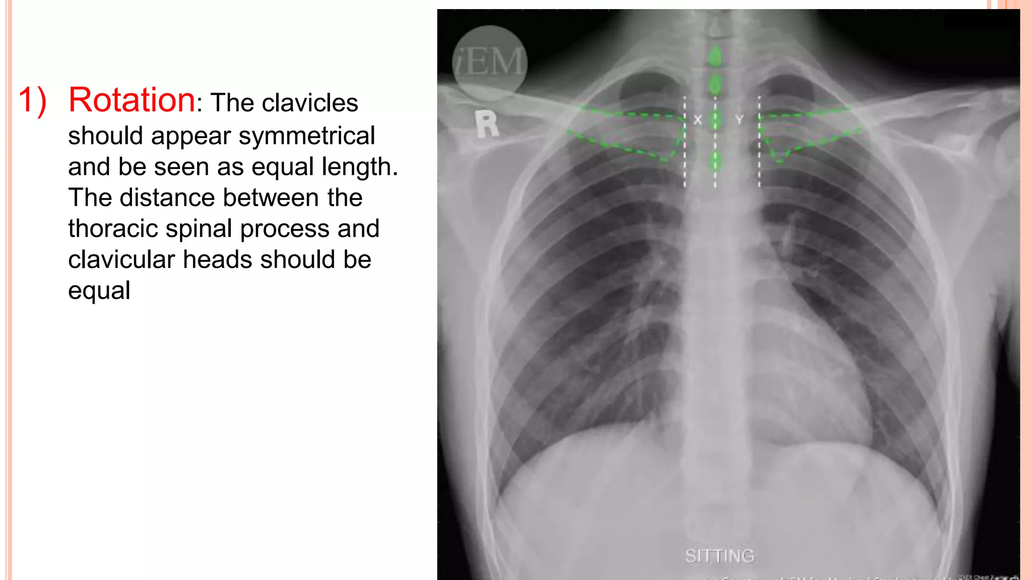 Thorax-XRAY and CT | PPTX