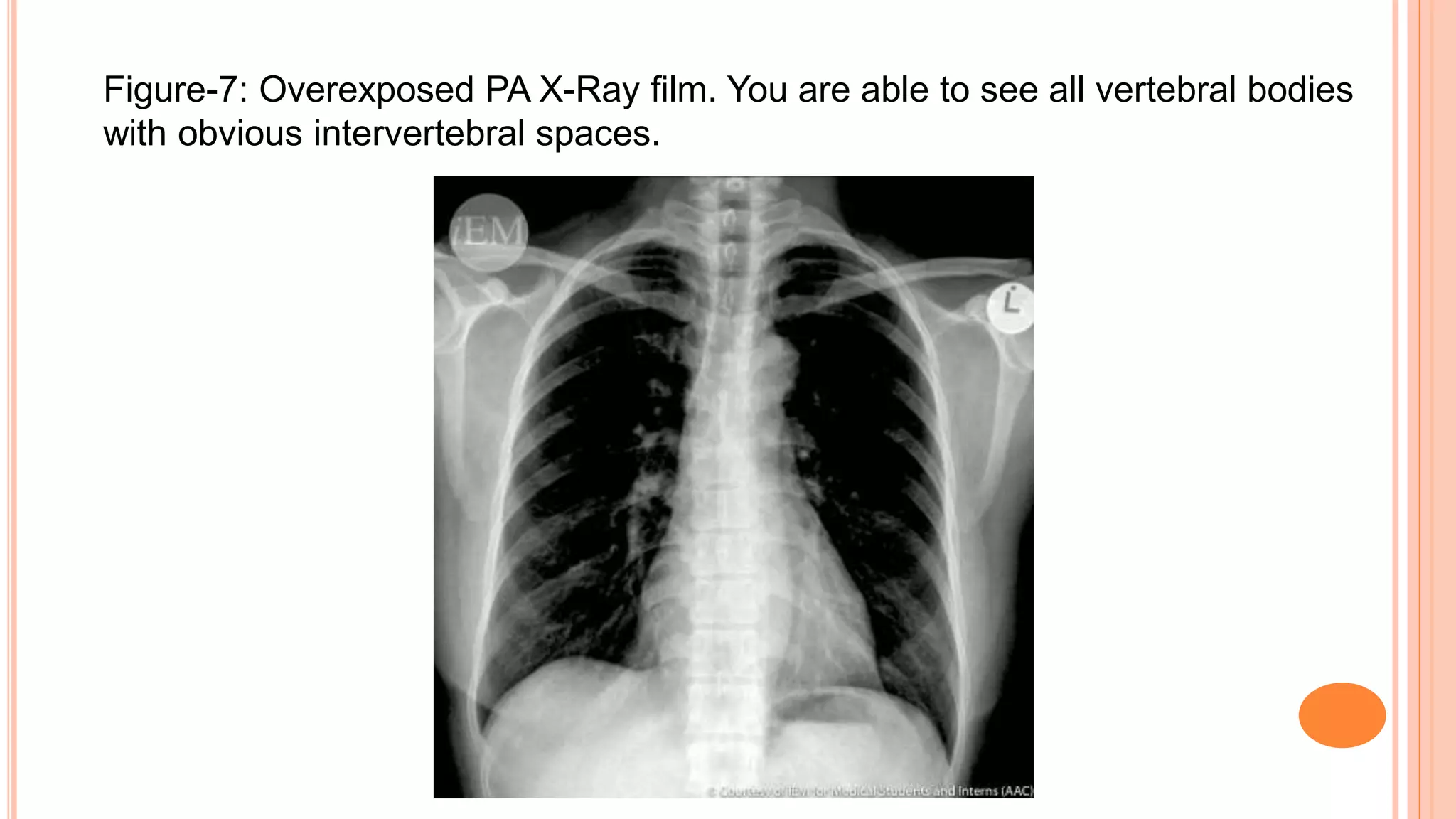Thorax-XRAY and CT | PPTX