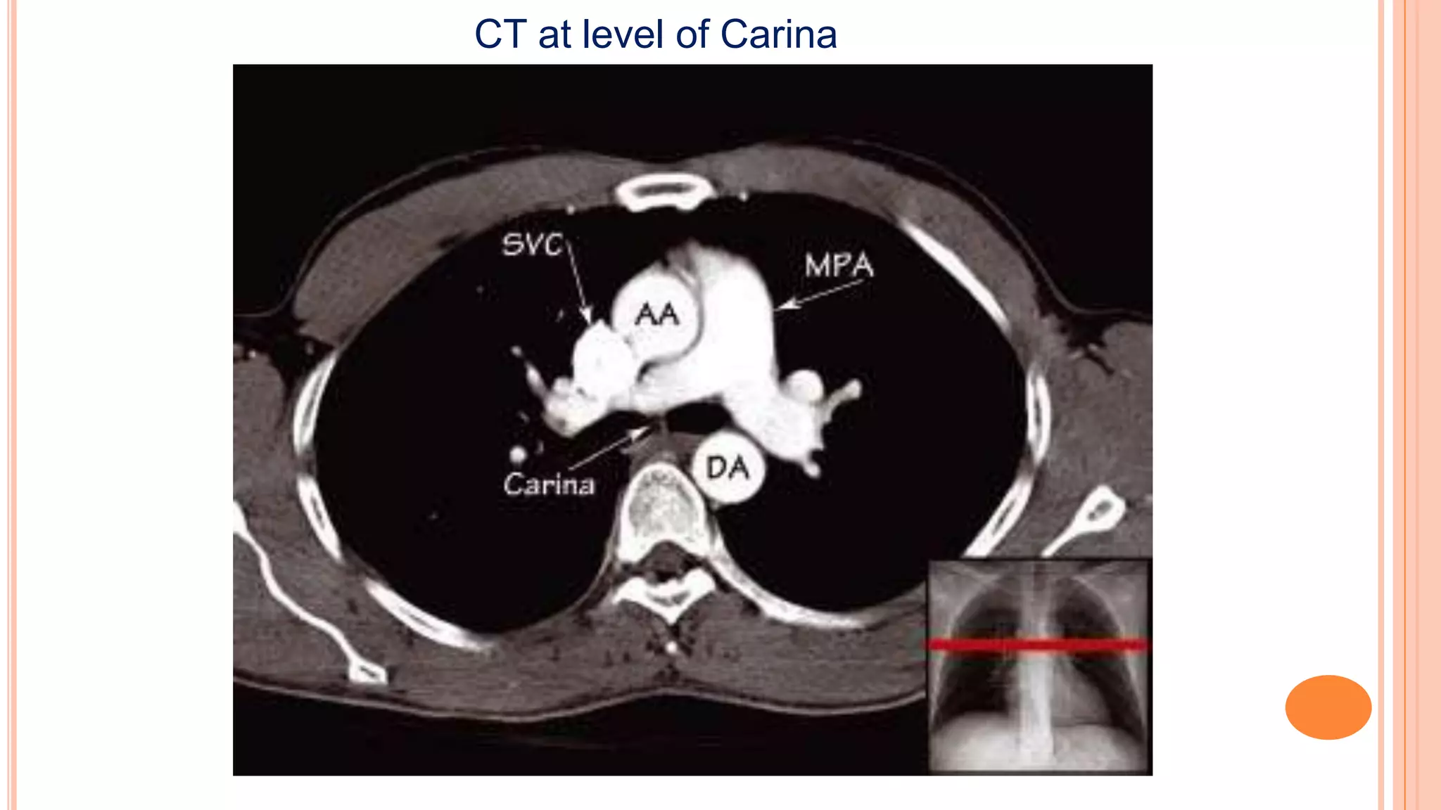 Thorax-XRAY and CT | PPTX