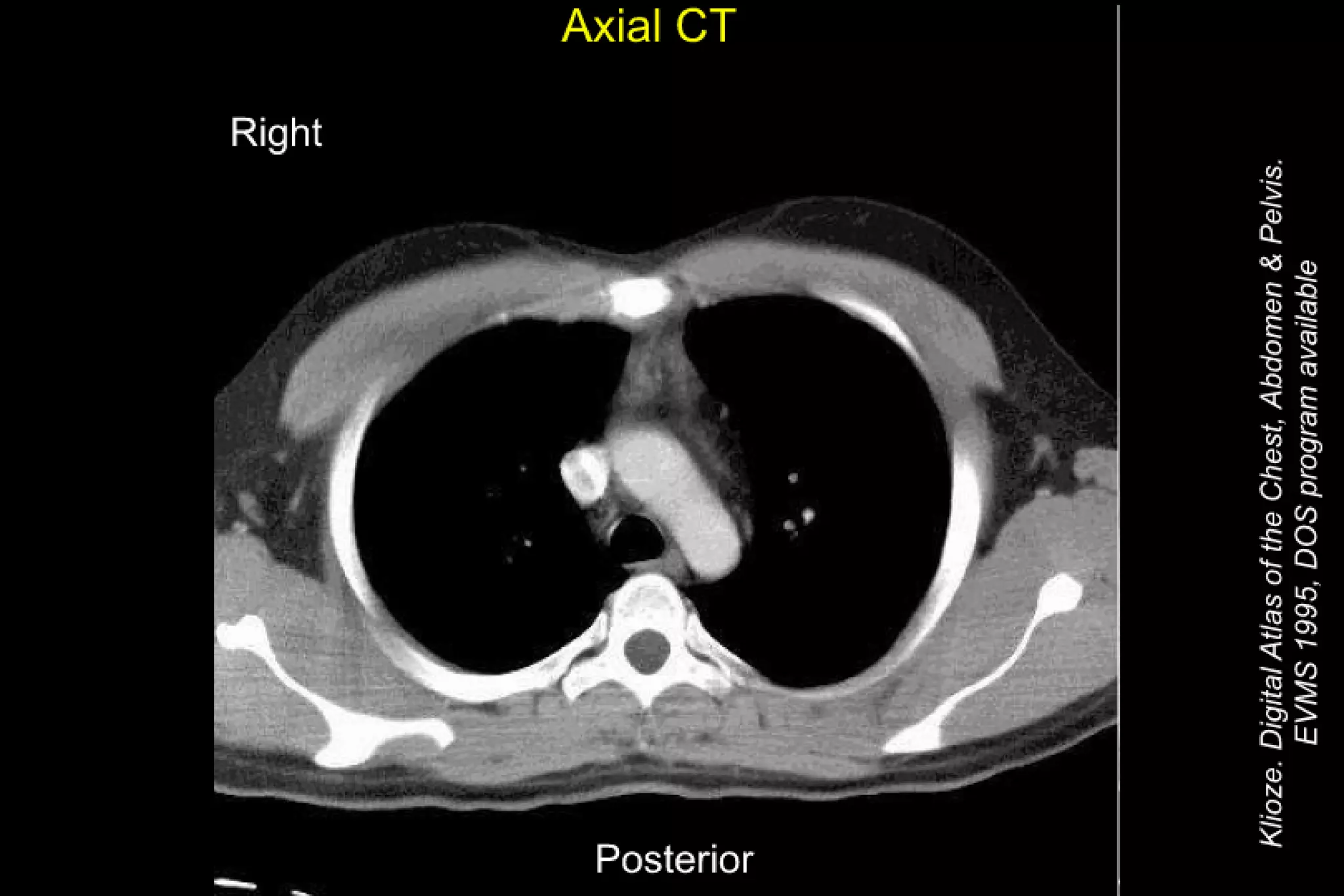 Thorax and Abdomen CT Cheat Sheet | PDF