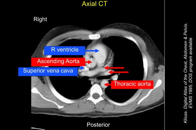 Thorax and Abdomen CT Cheat Sheet | PDF