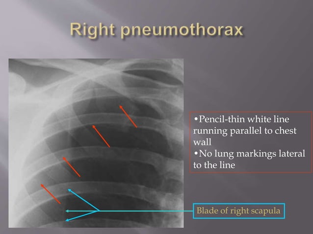 Thorax, heart, pericardium | PPT