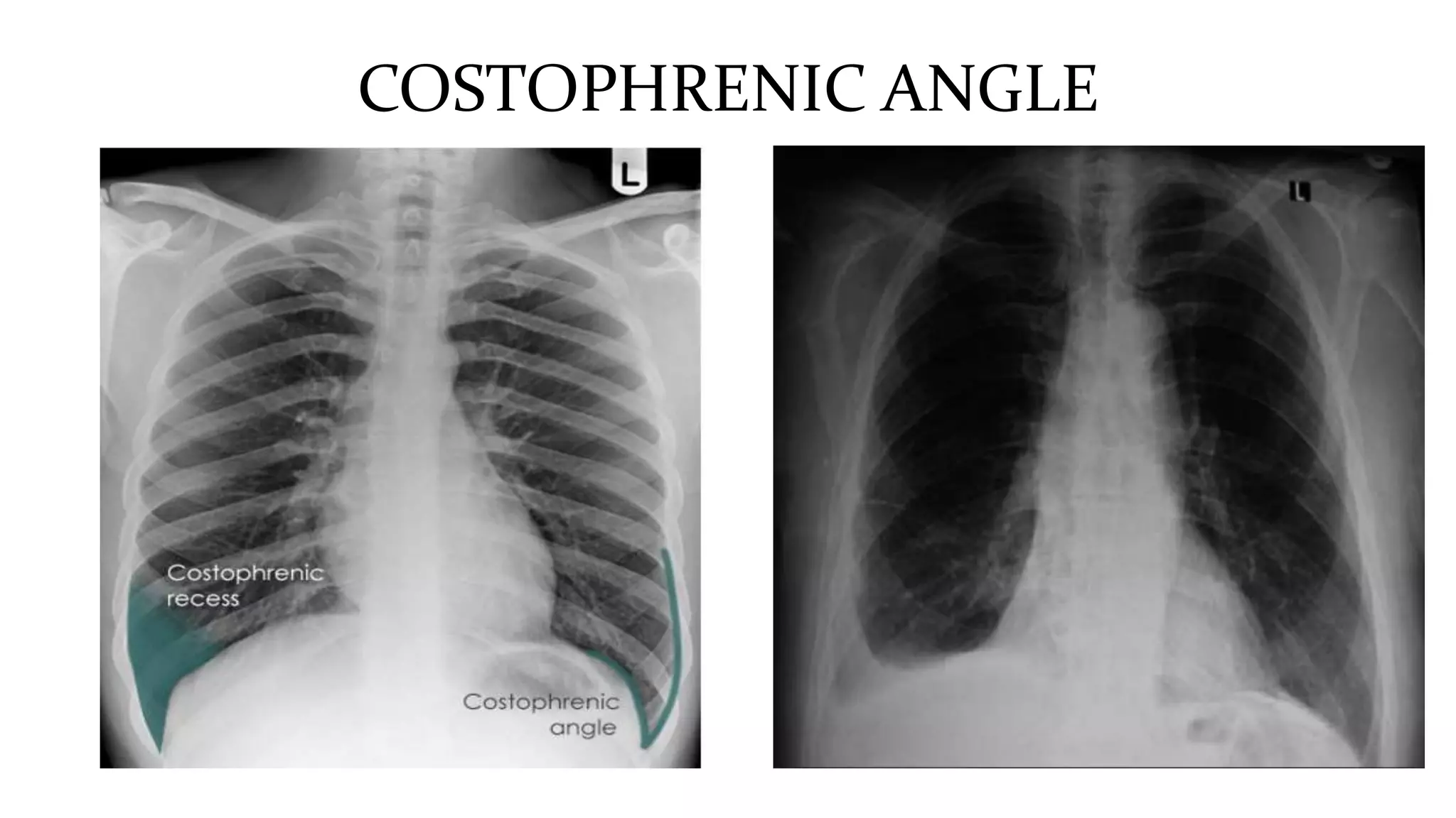 Thorax radiology | PPTX