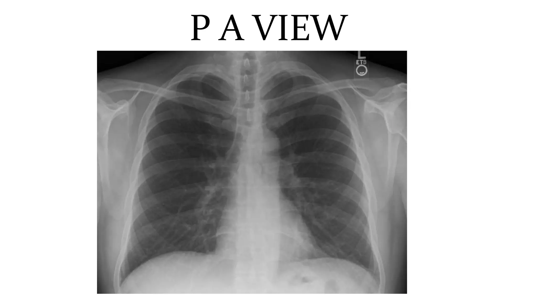 Thorax radiology | PPTX