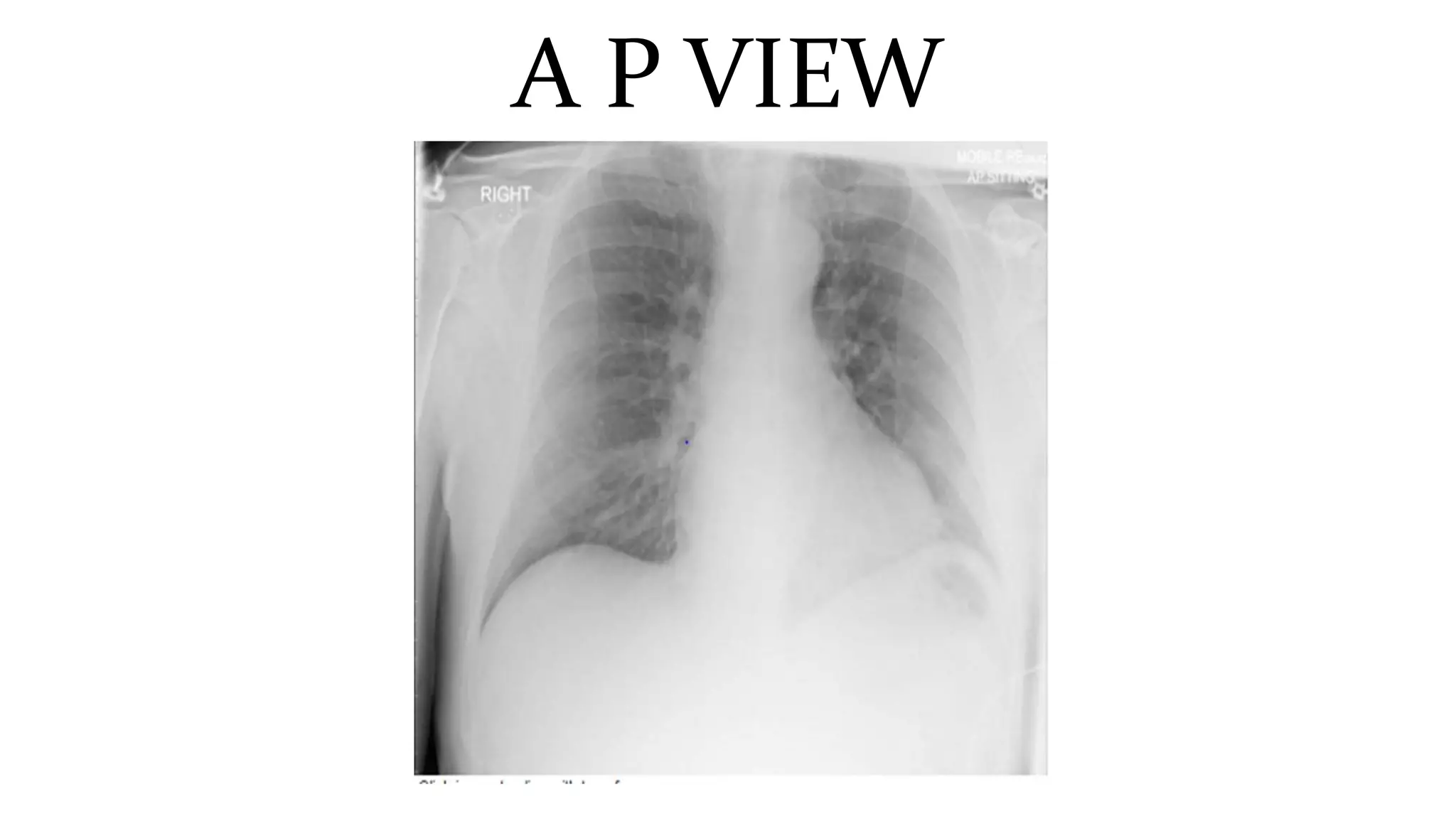 Thorax radiology | PPTX