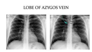 Thorax radiology | PPTX