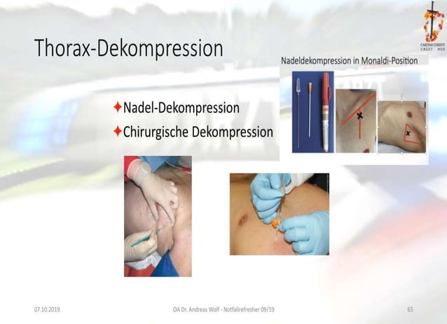 Thoraxdrainage Und Pneumothorax – CCVQN
