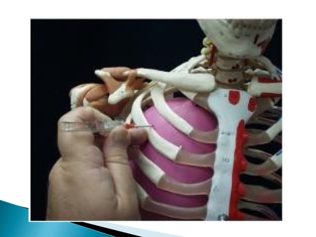 Thoracostomy indications and options | PPT