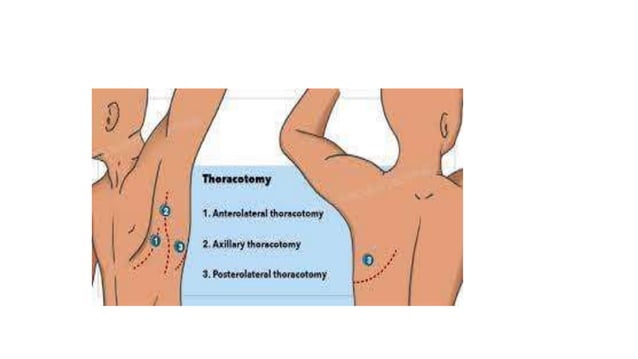 THORACOTOMY.pptx