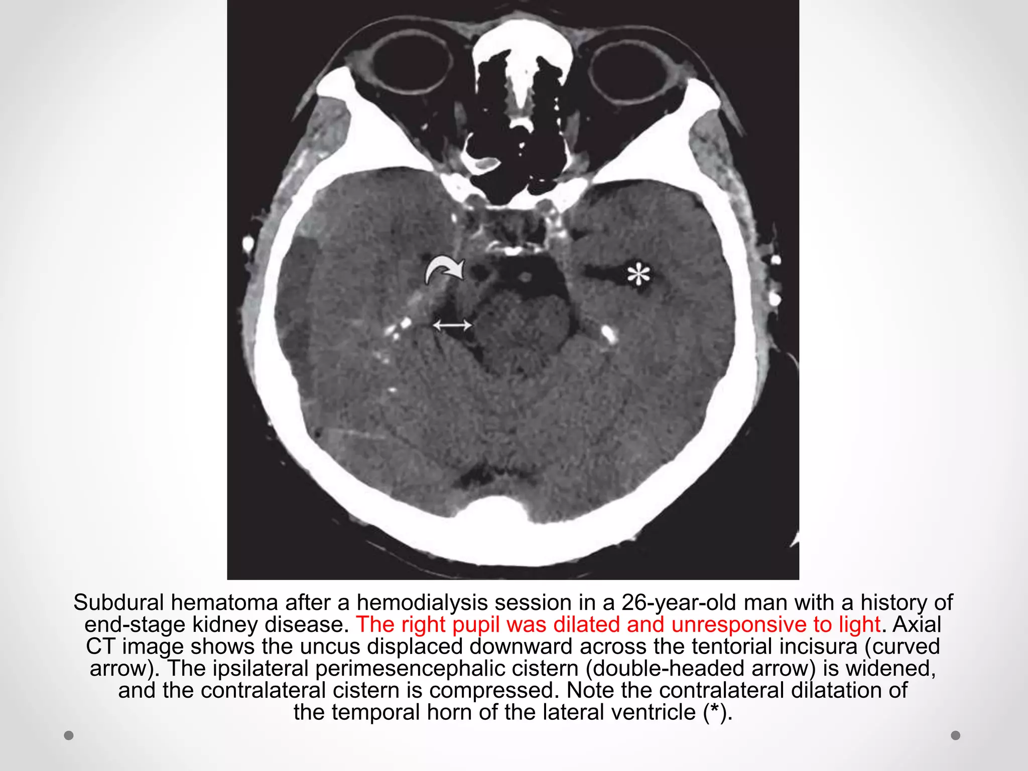 Thoát vị não | PPTX