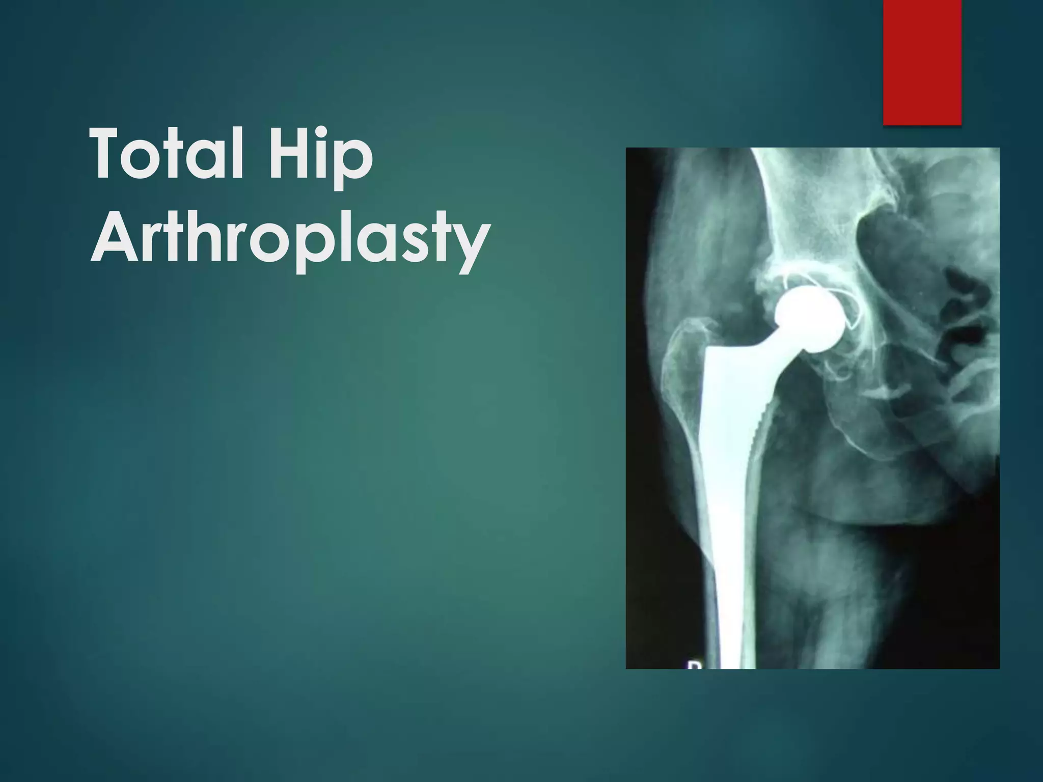 total hip arthroplasty | PPTX