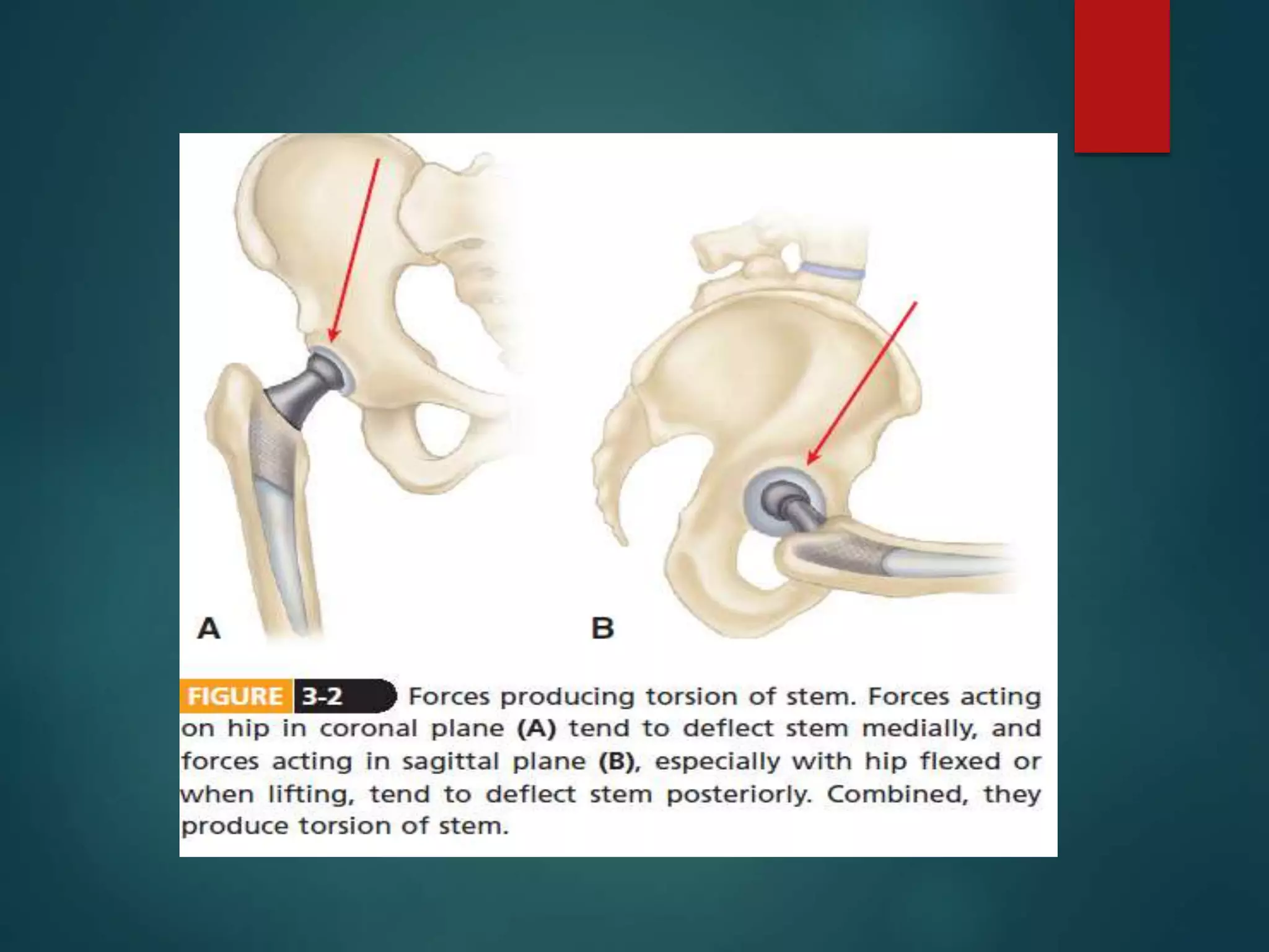 total hip arthroplasty | PPTX
