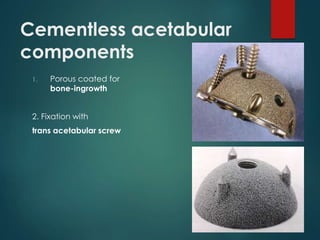 total hip arthroplasty | PPTX