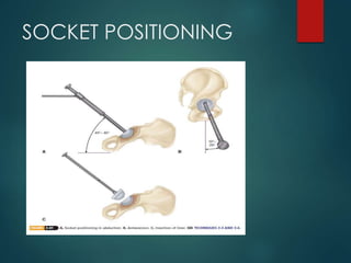 total hip arthroplasty | PPTX