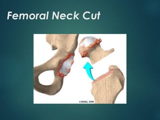 thr-ppt hip implant of human skeleton system -1.pdf