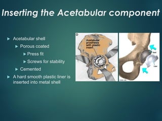 thr-ppt hip implant of human skeleton system -1.pdf