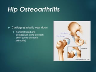 thr-ppt hip implant of human skeleton system -1.pdf