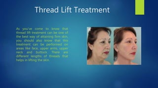 Thread lift treatment | PPTX