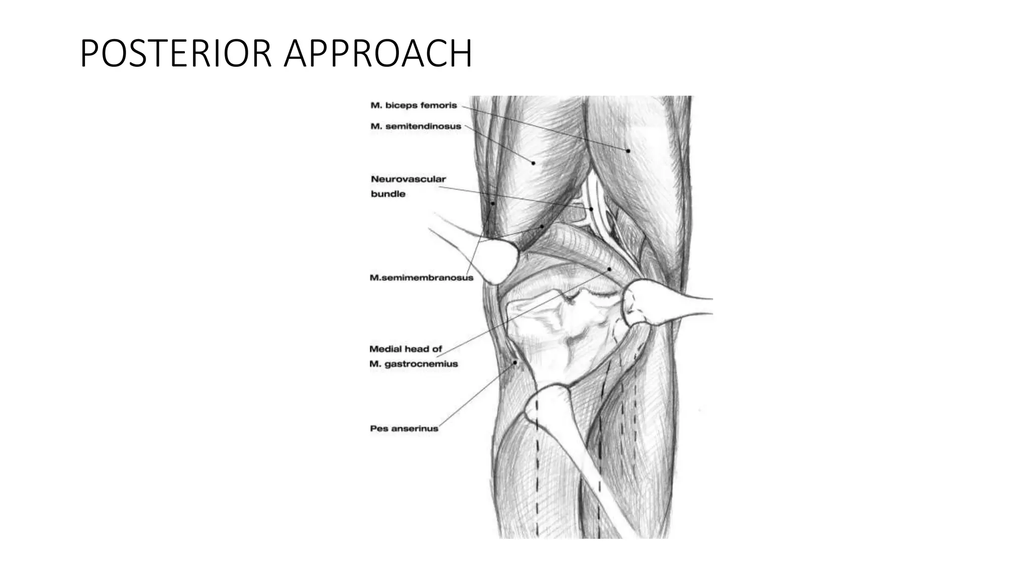 Three column fixation for complex PROXIMAL TIBIA FRACTURES | PPTX