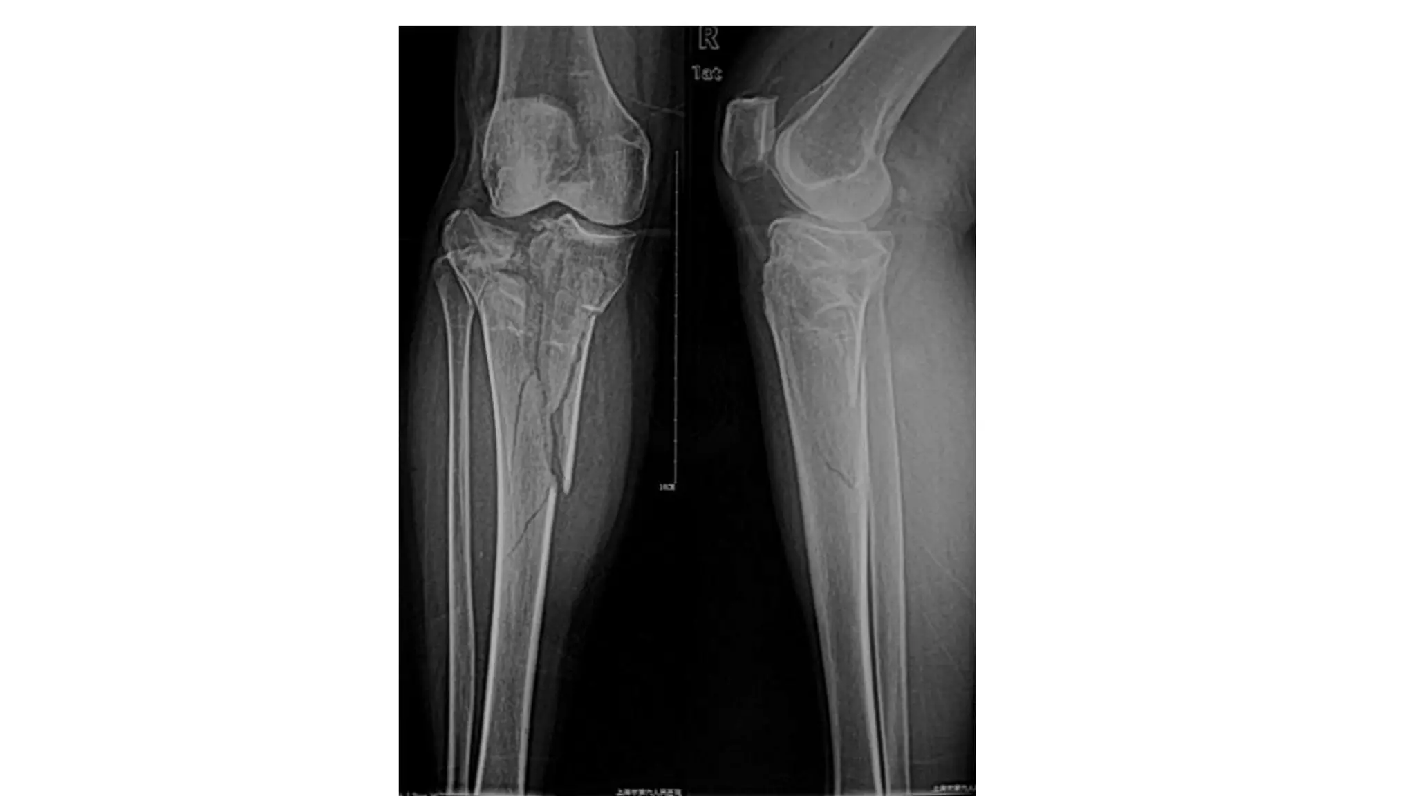 Three column fixation for complex PROXIMAL TIBIA FRACTURES | PPTX