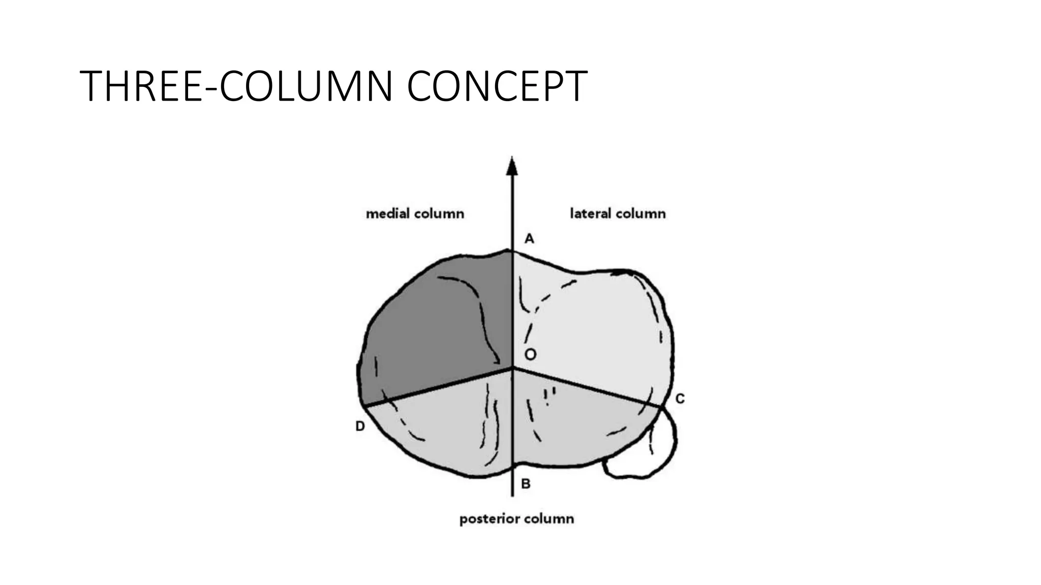 Three column fixation for complex PROXIMAL TIBIA FRACTURES | PPTX