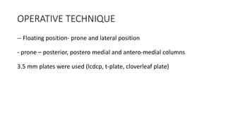 Three column fixation for complex PROXIMAL TIBIA FRACTURES | PPTX