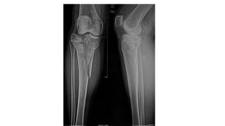 Three column fixation for complex PROXIMAL TIBIA FRACTURES | PPTX