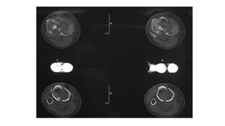 Three column fixation for complex PROXIMAL TIBIA FRACTURES | PPTX