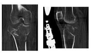 Three column fixation for complex PROXIMAL TIBIA FRACTURES | PPTX