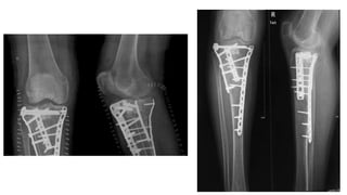 Three column fixation for complex PROXIMAL TIBIA FRACTURES | PPTX