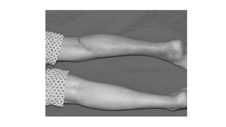 Three column fixation for complex PROXIMAL TIBIA FRACTURES | PPTX