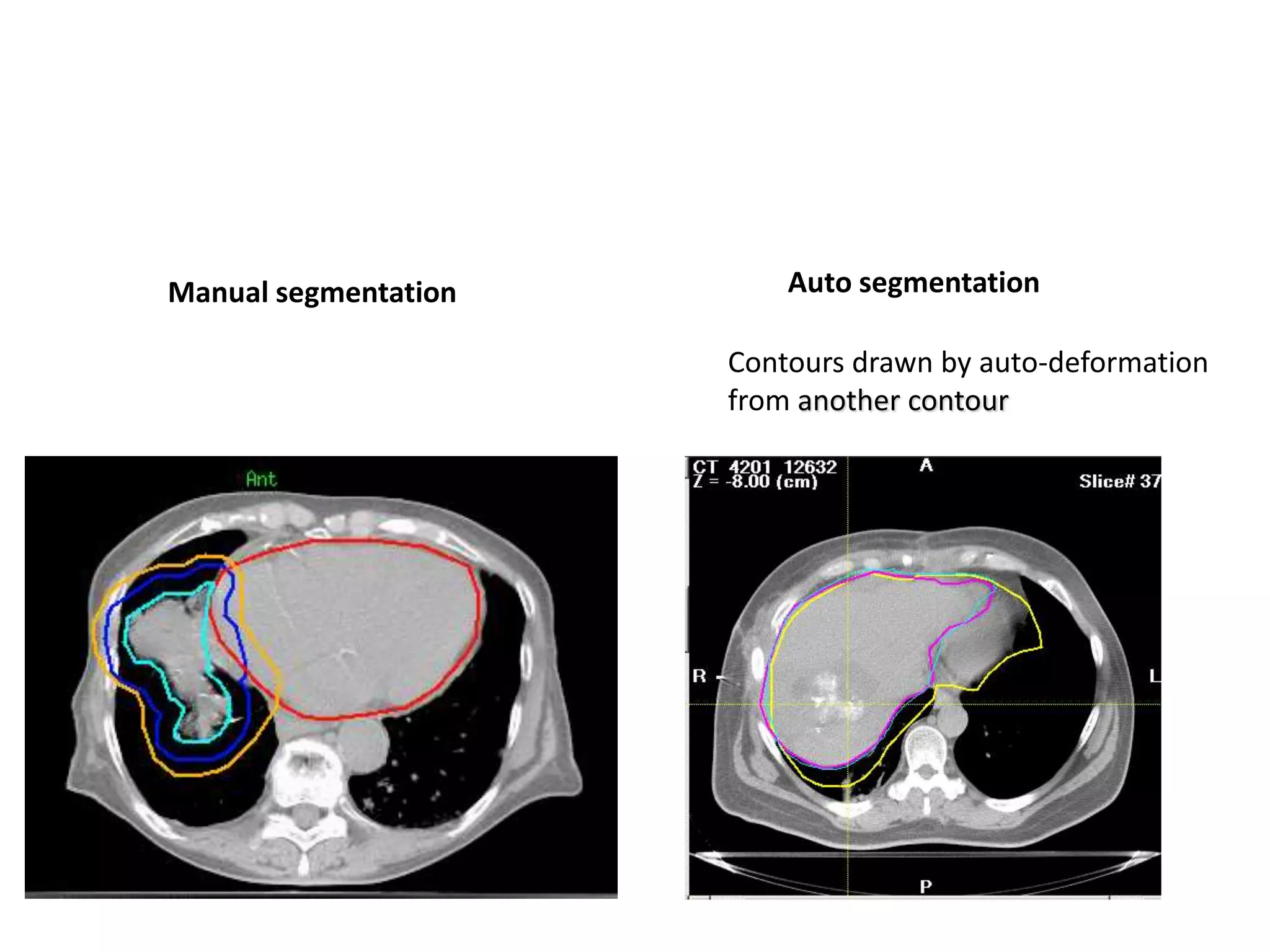 Three dimensional conformal radiation therapy | PPTX | 3-D Graphics ...