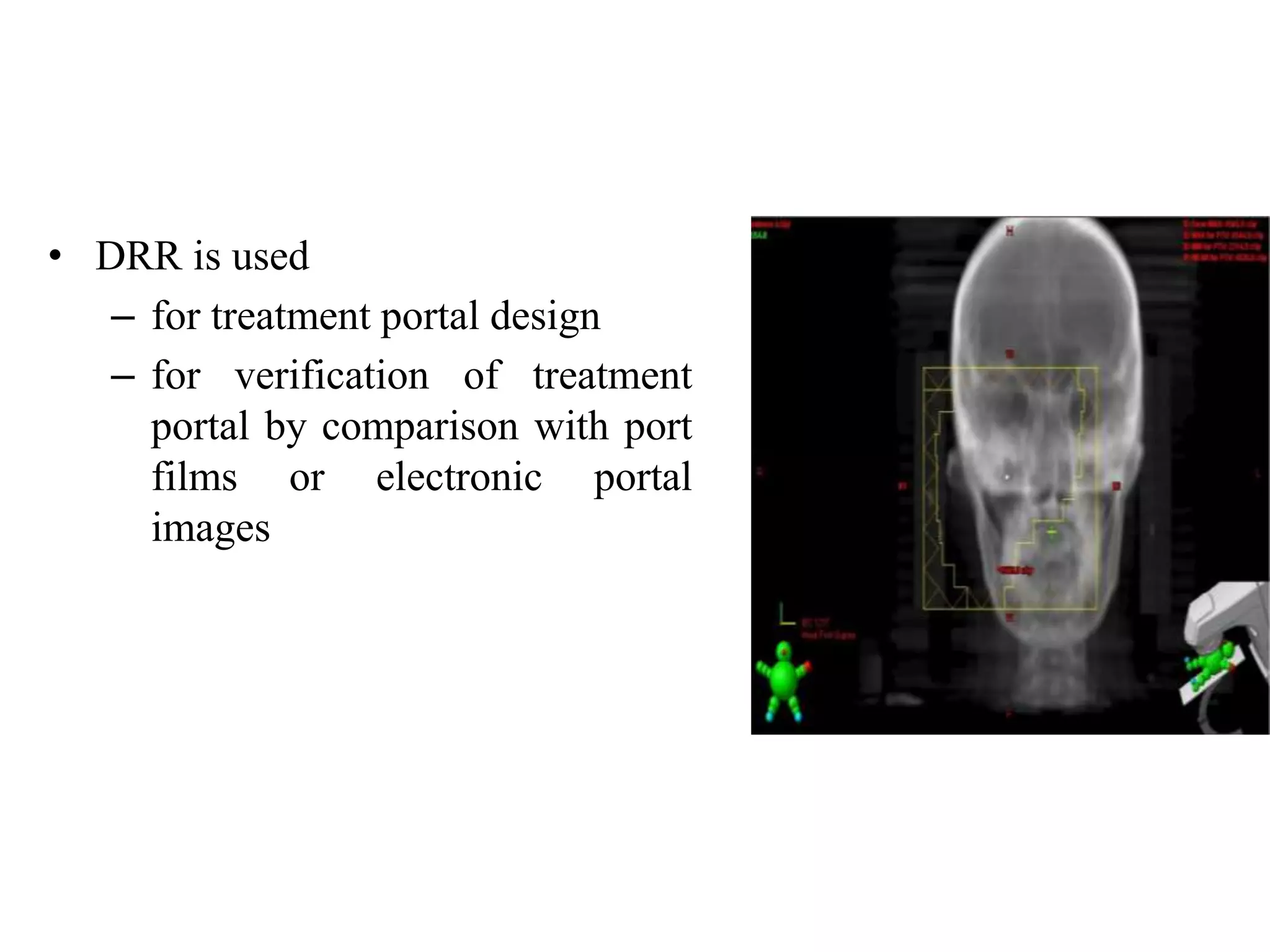 Three dimensional conformal radiation therapy | PPTX