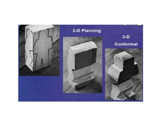 Three dimensional conformal radiation therapy | PPTX