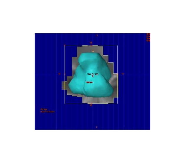 Three dimensional conformal radiation therapy | PPTX | 3-D Graphics ...