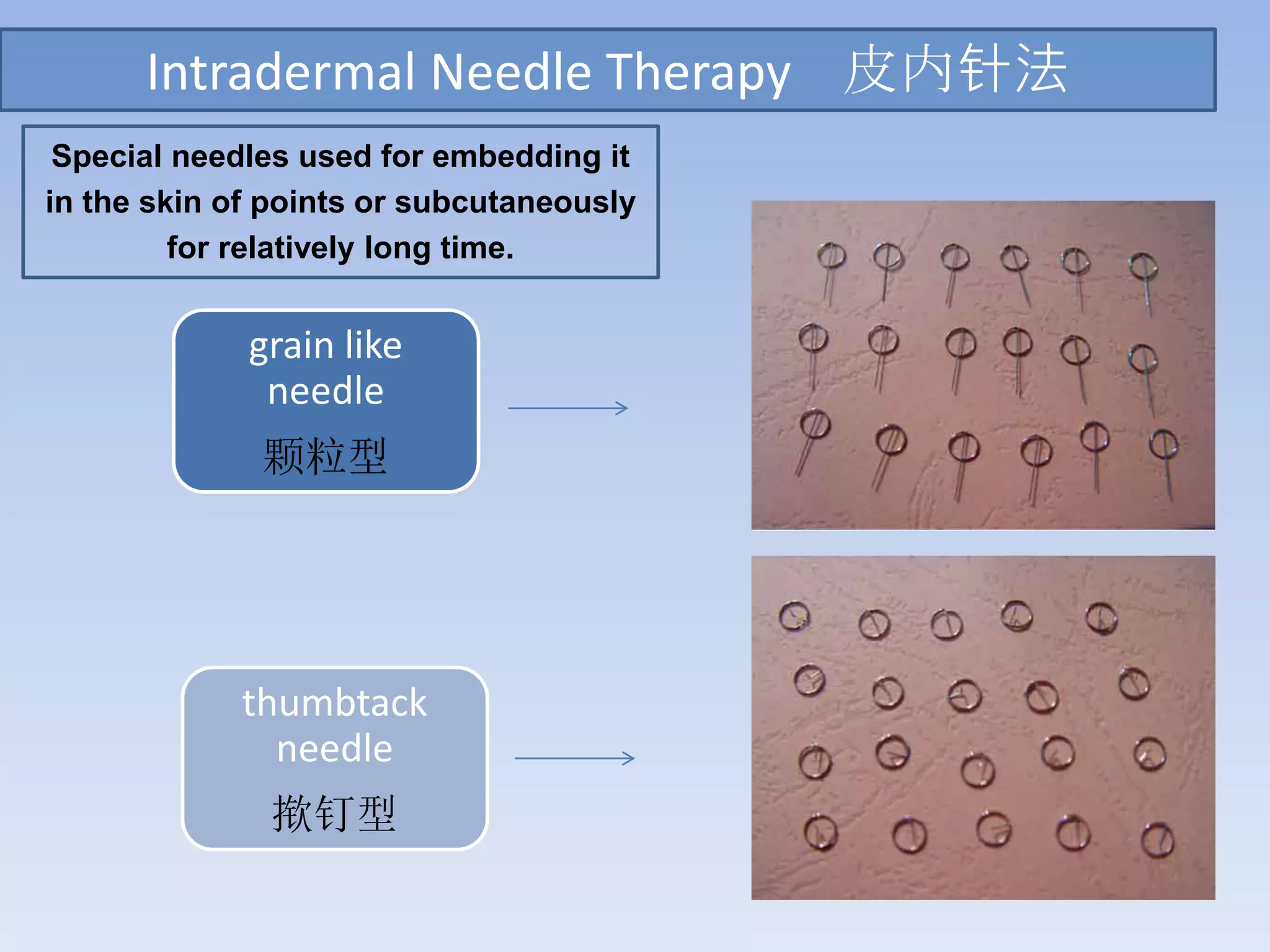 Three edged cutaneous - intradermal needle therapy | PPT