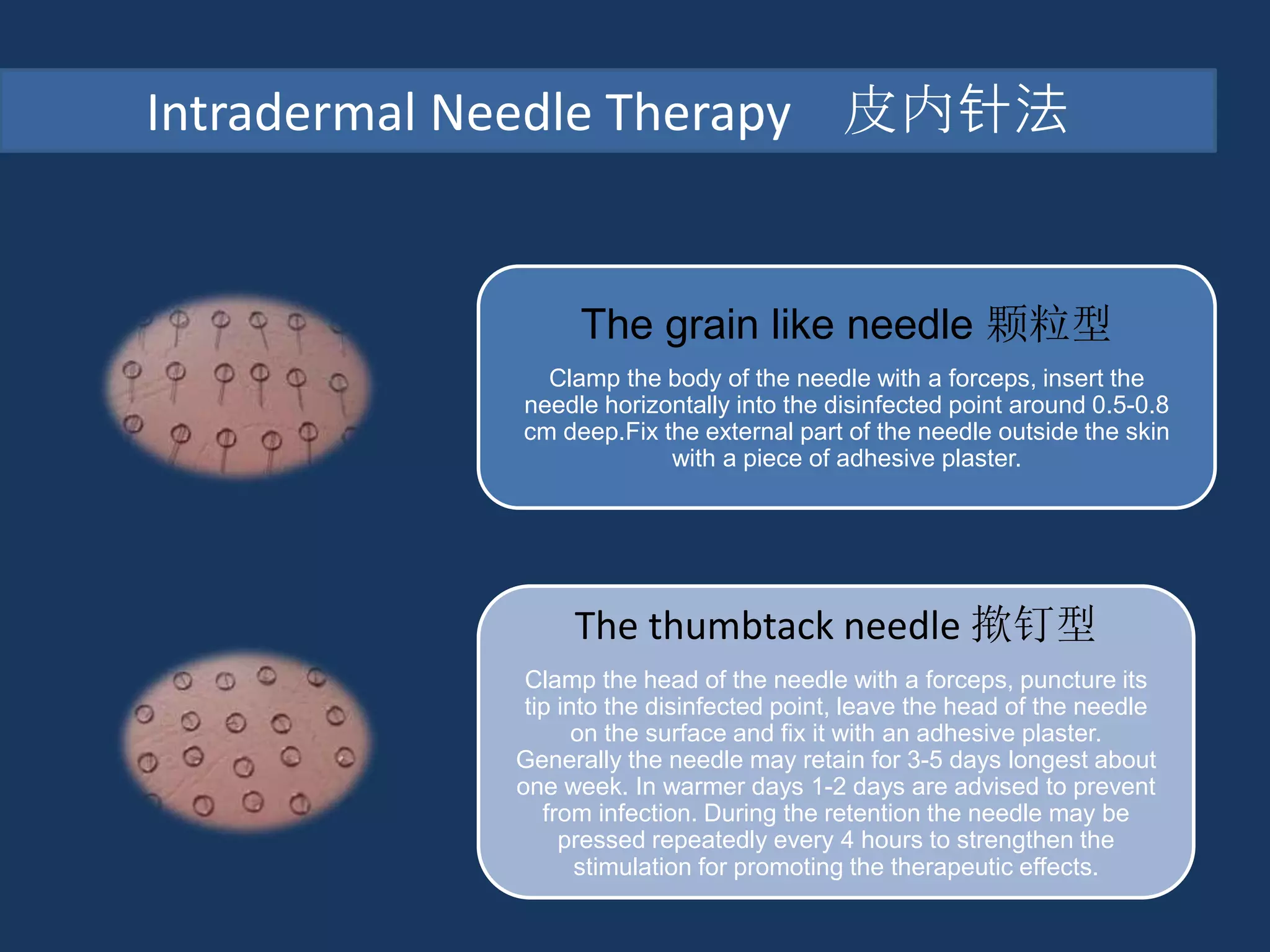 Three edged cutaneous - intradermal needle therapy | PPT