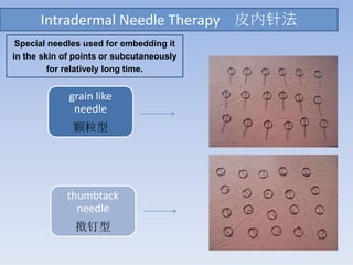 Three edged cutaneous - intradermal needle therapy | PPT