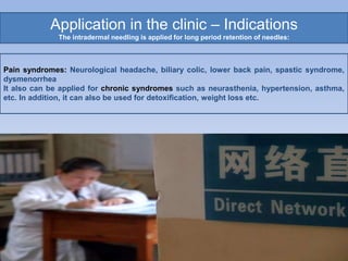 Three edged cutaneous - intradermal needle therapy | PPT